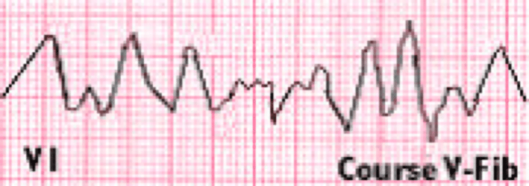 Advanced ACLS Course : Ventricular Fibrillation & Pulseless VT