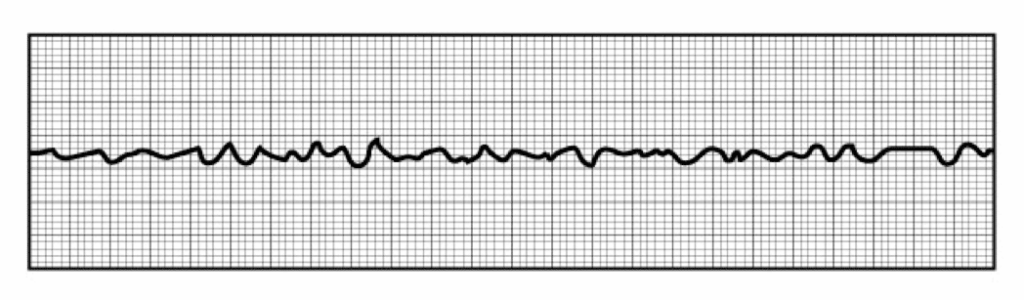 Advanced ACLS Course : Ventricular Fibrillation & Pulseless VT